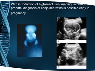 cranio-Cephalopagus | PPT