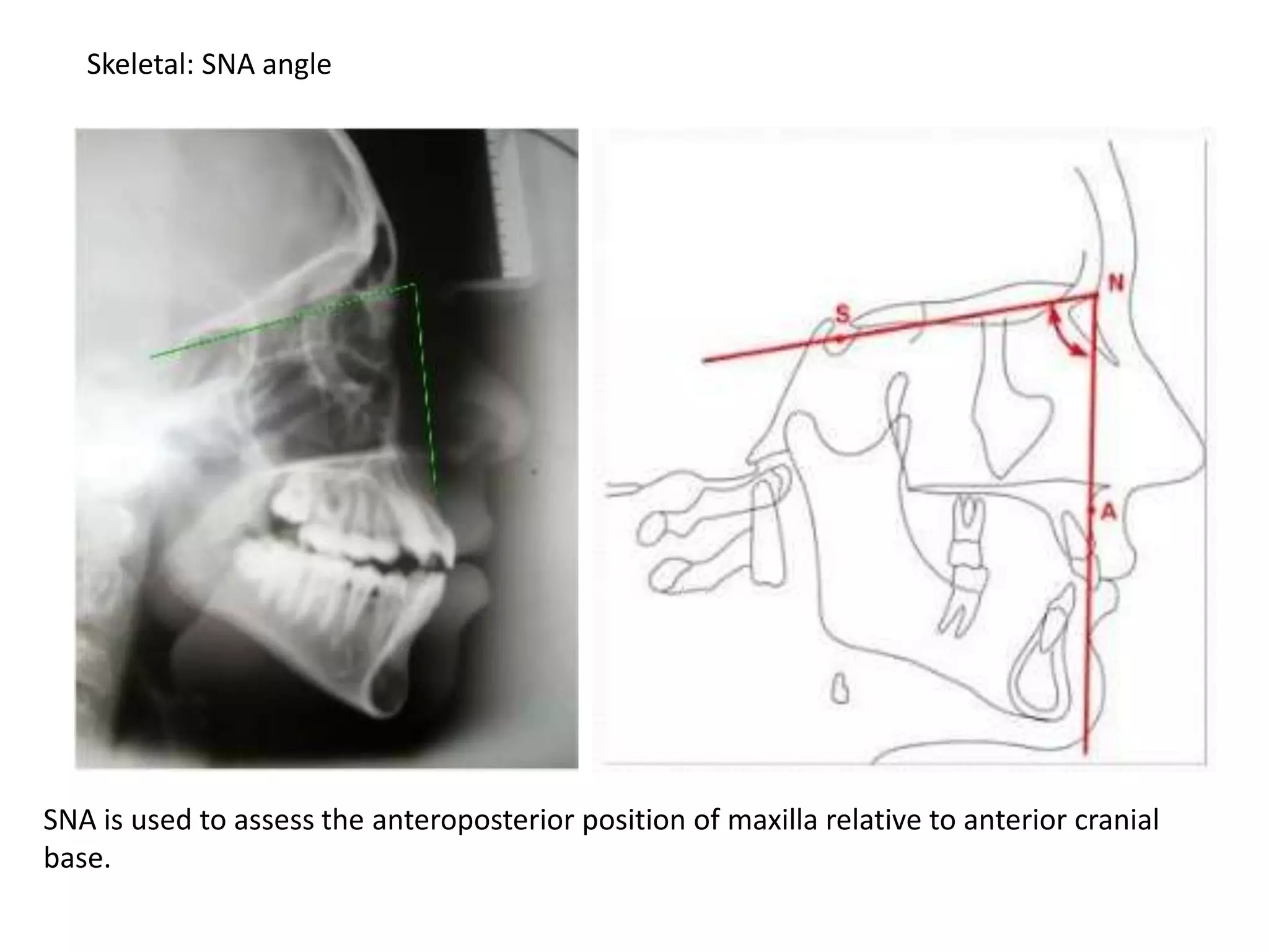 Cephalometric analysis | PPTX