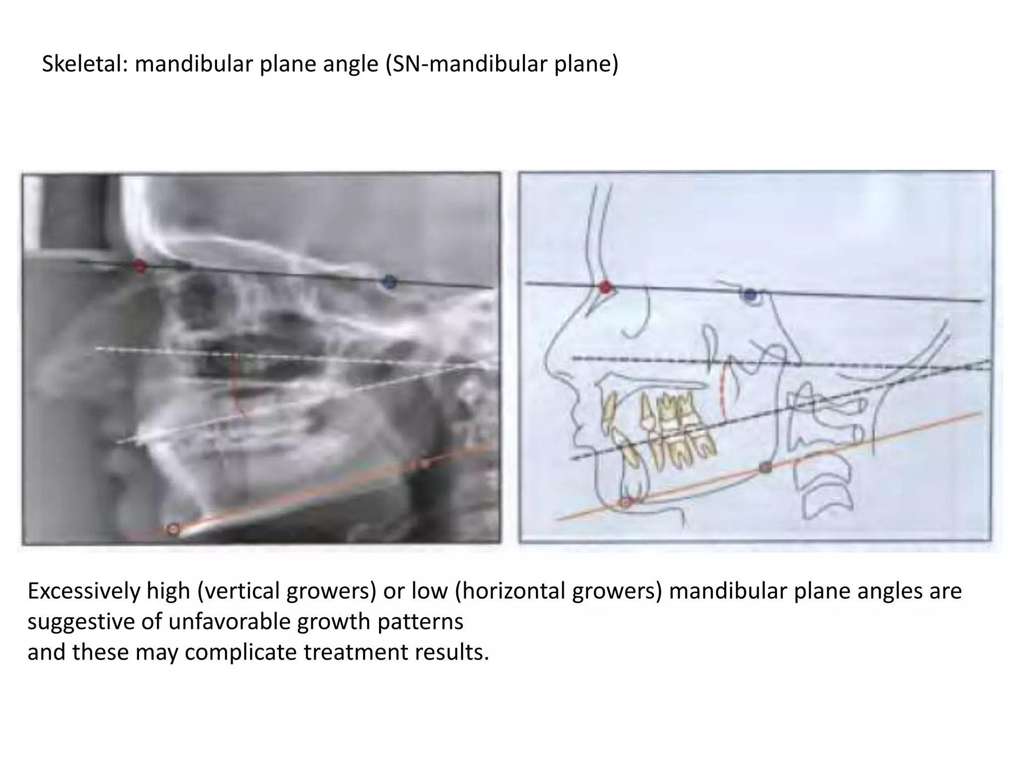 Cephalometric analysis | PPTX