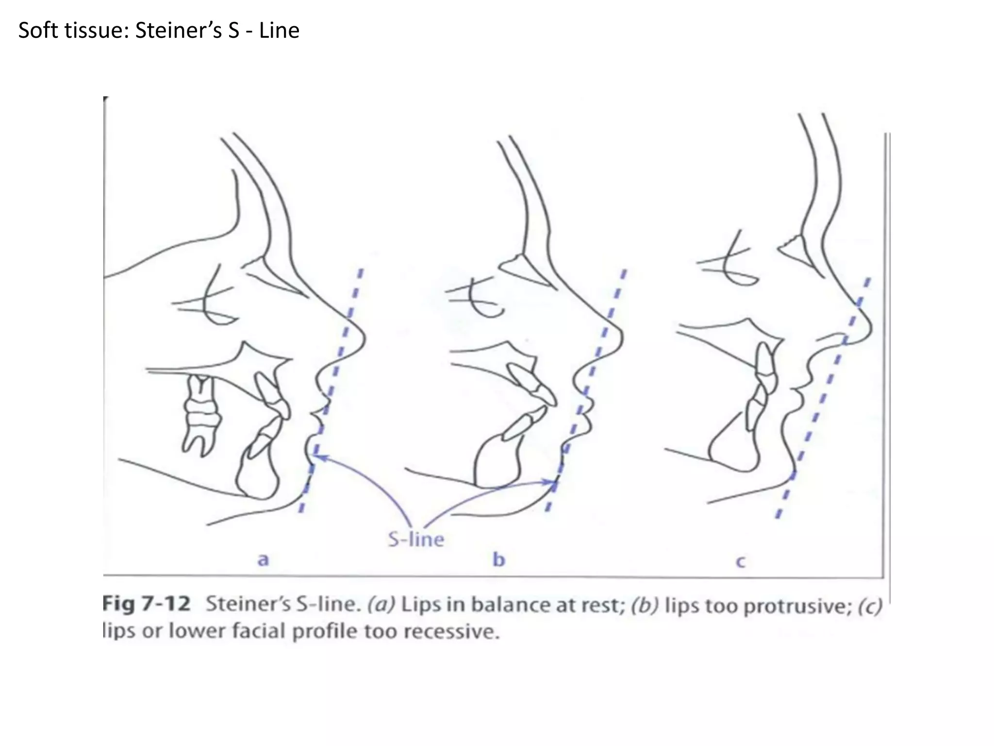 Cephalometric analysis | PPTX