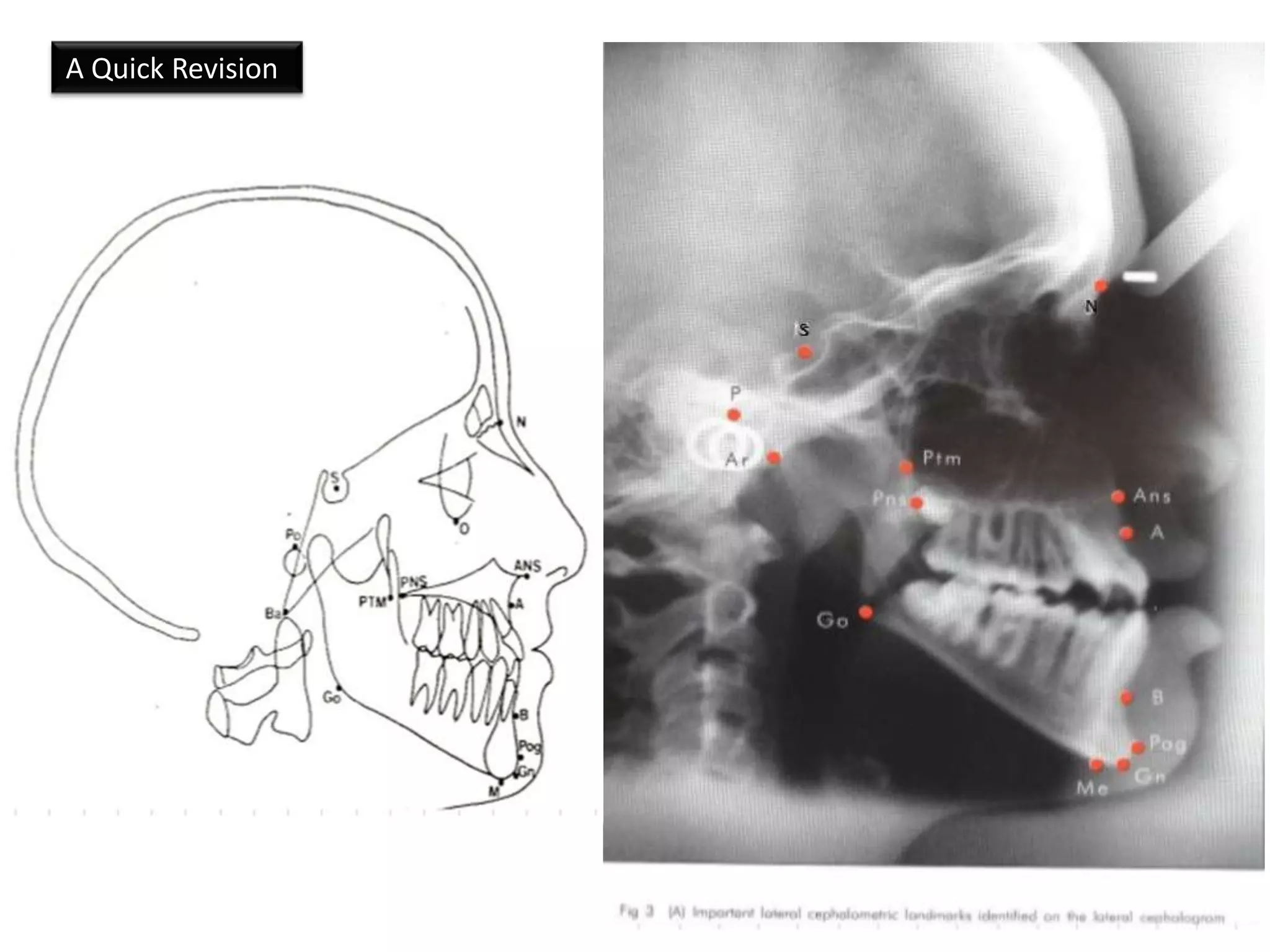 Cephalometric analysis | PPTX