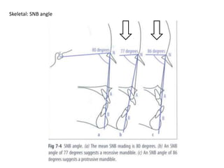 Cephalometric analysis | PPTX