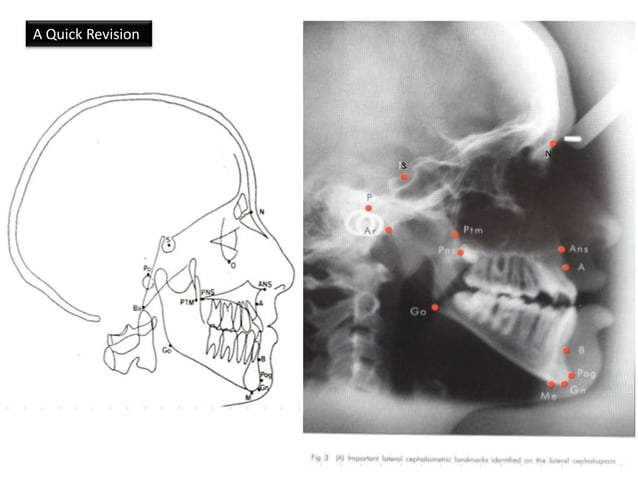 Cephalometric analysis | PPTX | Dental Health | Diseases and Conditions