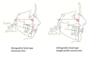 Cephalometric analysis | PPTX
