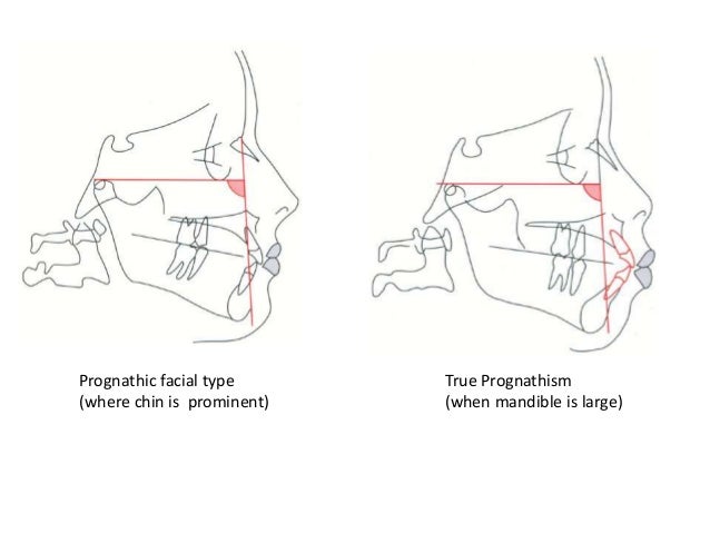 Cephalometric analysis