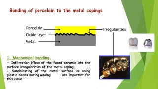 Dental Ceramics and Porcelain fused to metal | PPTX