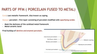 Dental Ceramics and Porcelain fused to metal | PPTX