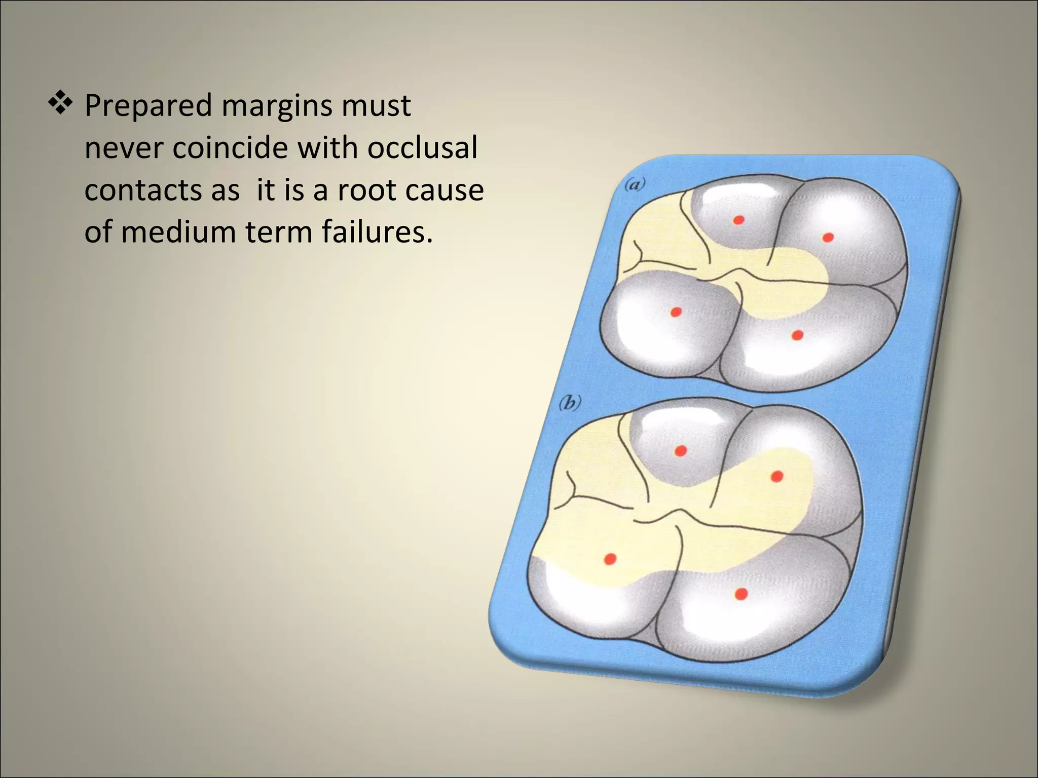 Ceramic inlays and onlays | PPT