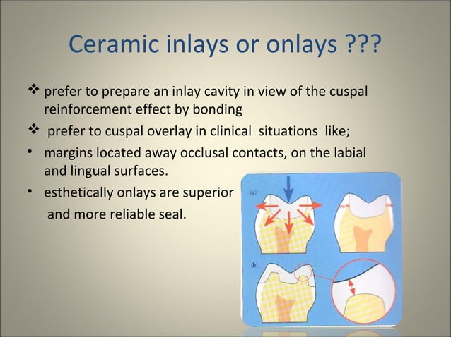 Ceramic inlays and onlays | PPT | Dental Health | Diseases and Conditions