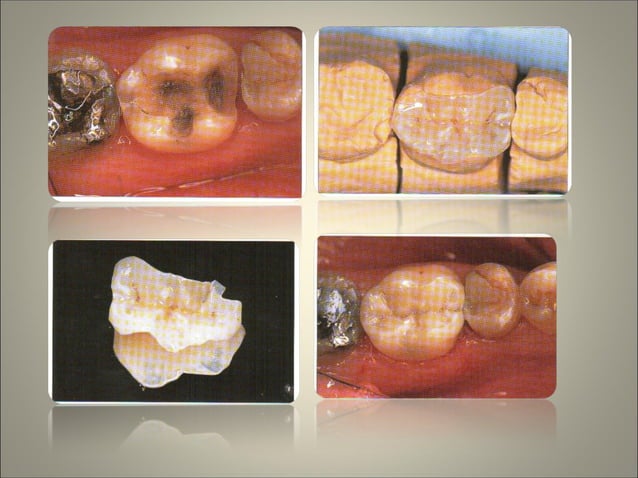 Ceramic inlays and onlays | PPT | Dental Health | Diseases and Conditions