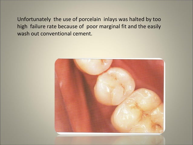 Ceramic inlays and onlays | PPT | Dental Health | Diseases and Conditions