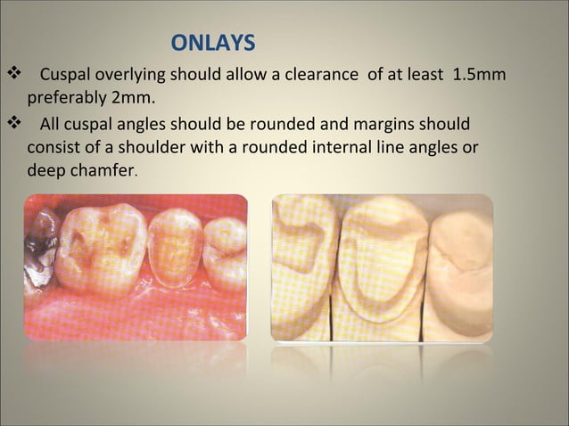 Ceramic inlays and onlays | PPT