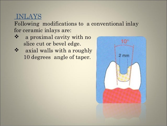 Ceramic inlays and onlays