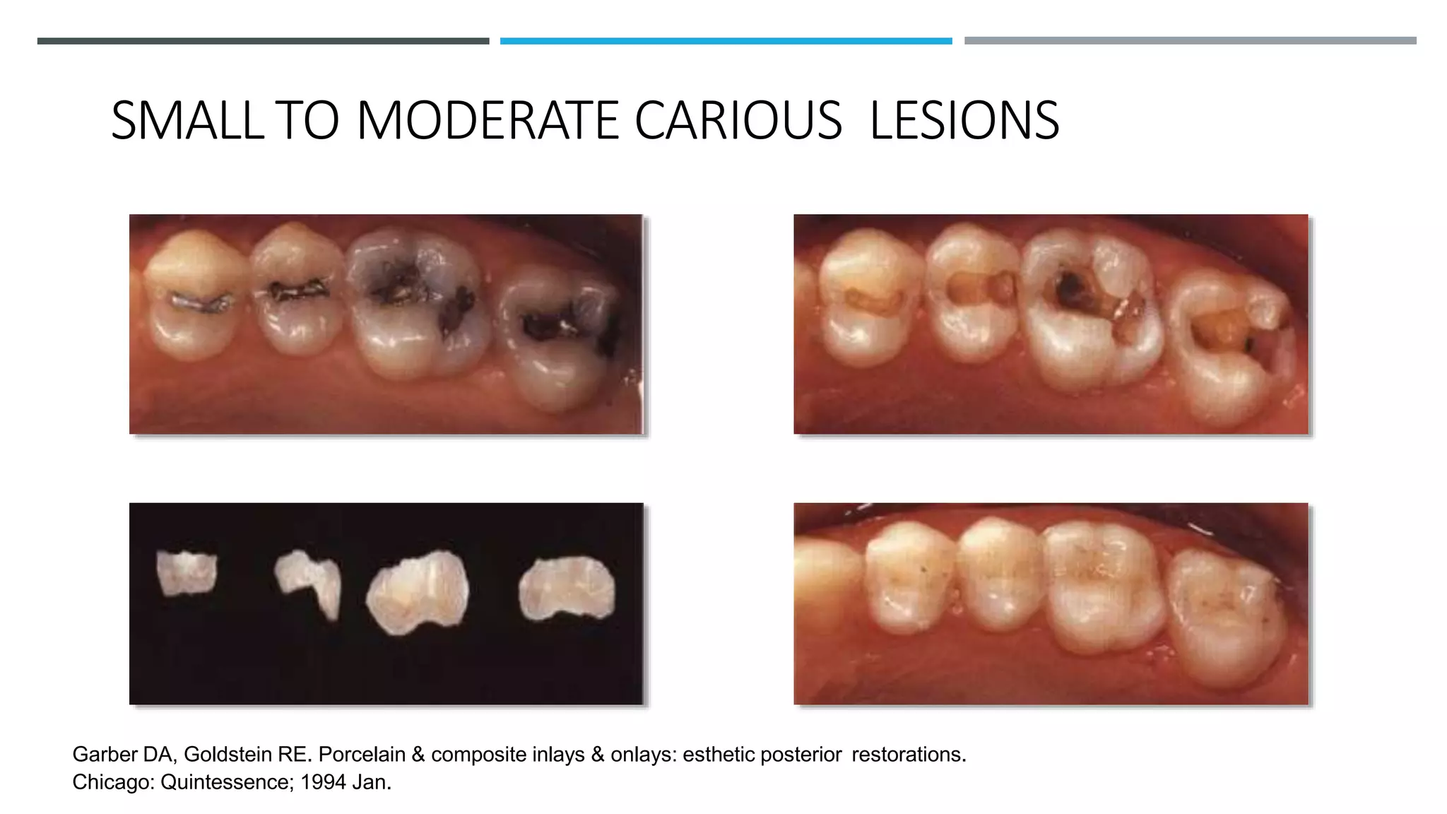 Ceramic inlays and onlays | PPTX | Dental Health | Diseases and Conditions