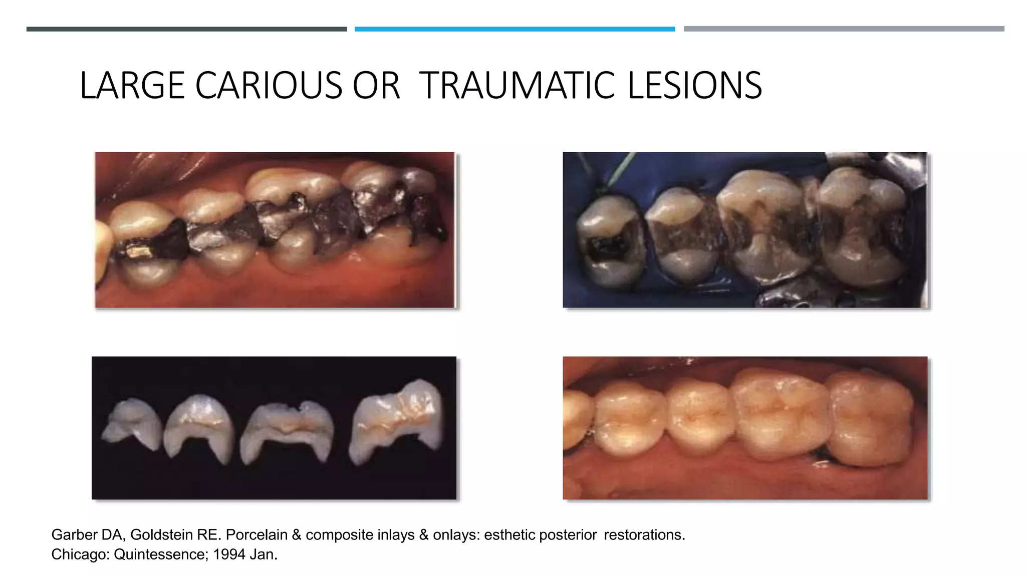 Ceramic inlays and onlays | PPTX