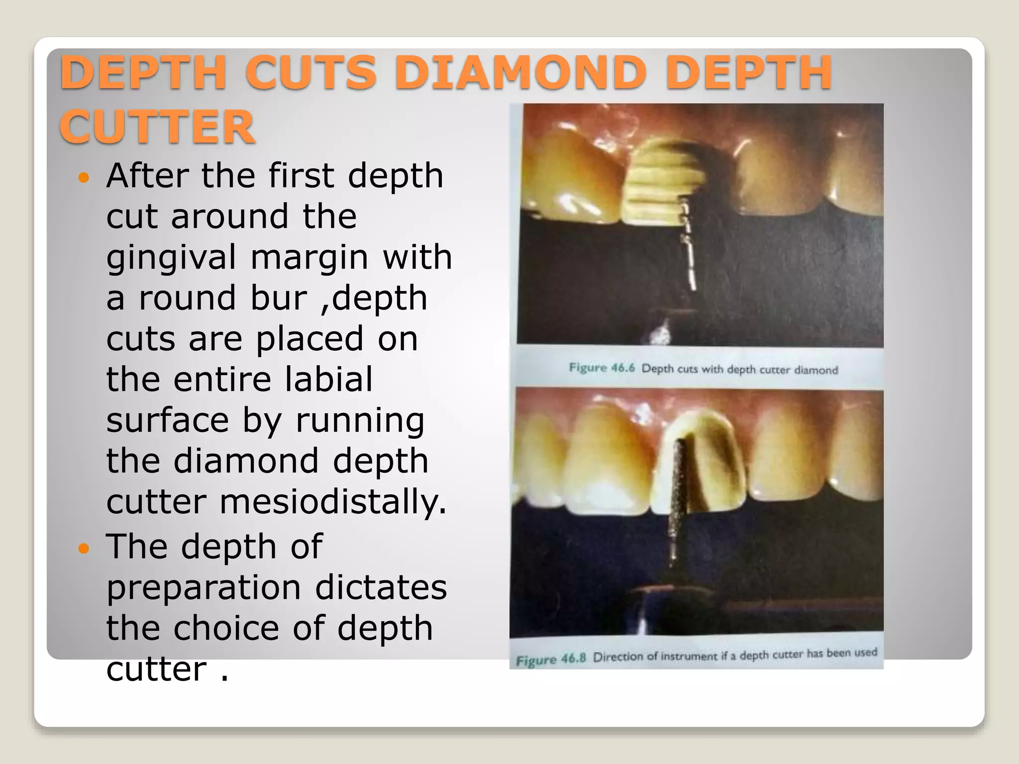 CERAMIC LAMINATE VENEERS.pptx