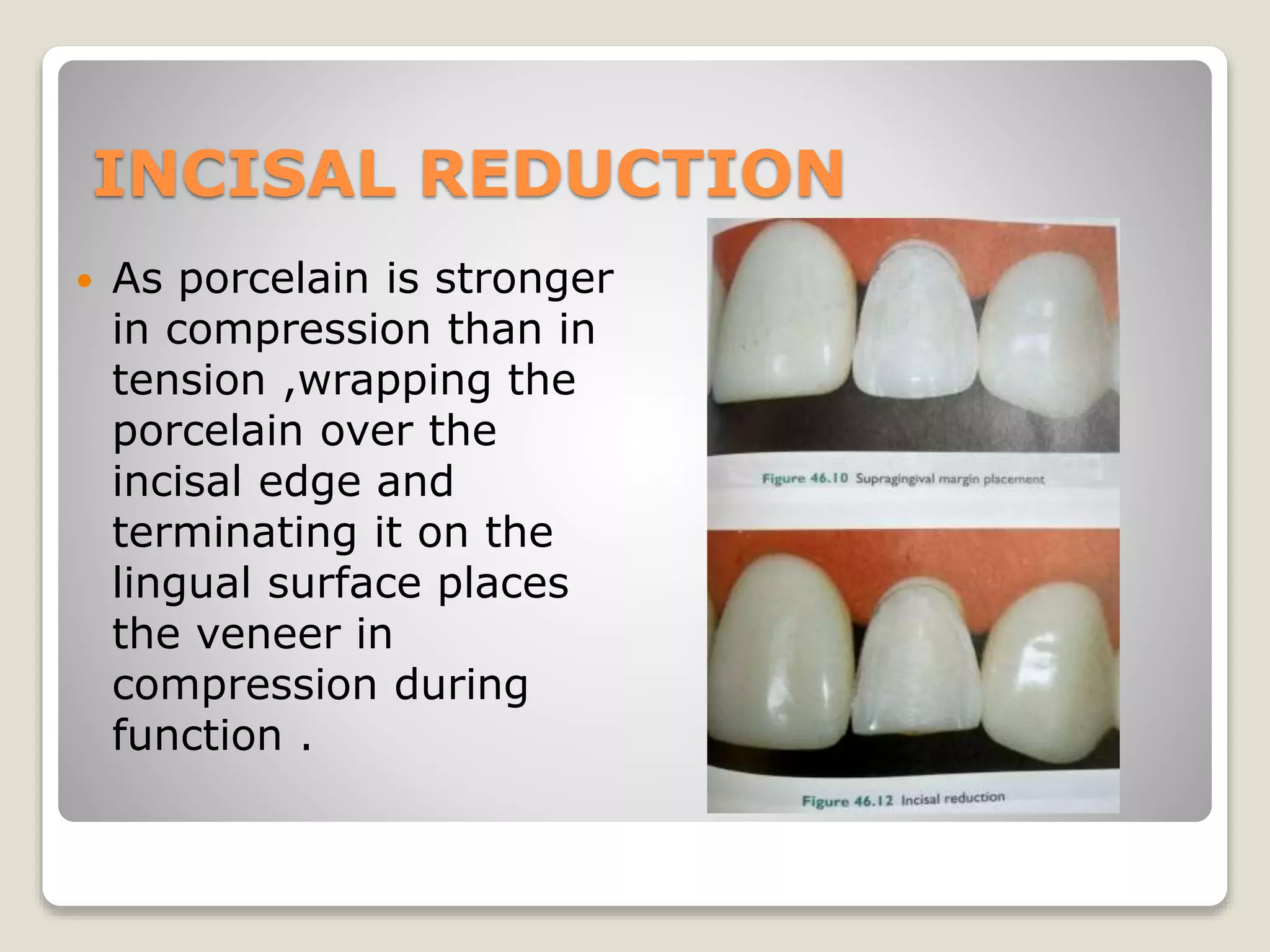 CERAMIC LAMINATE VENEERS.pptx