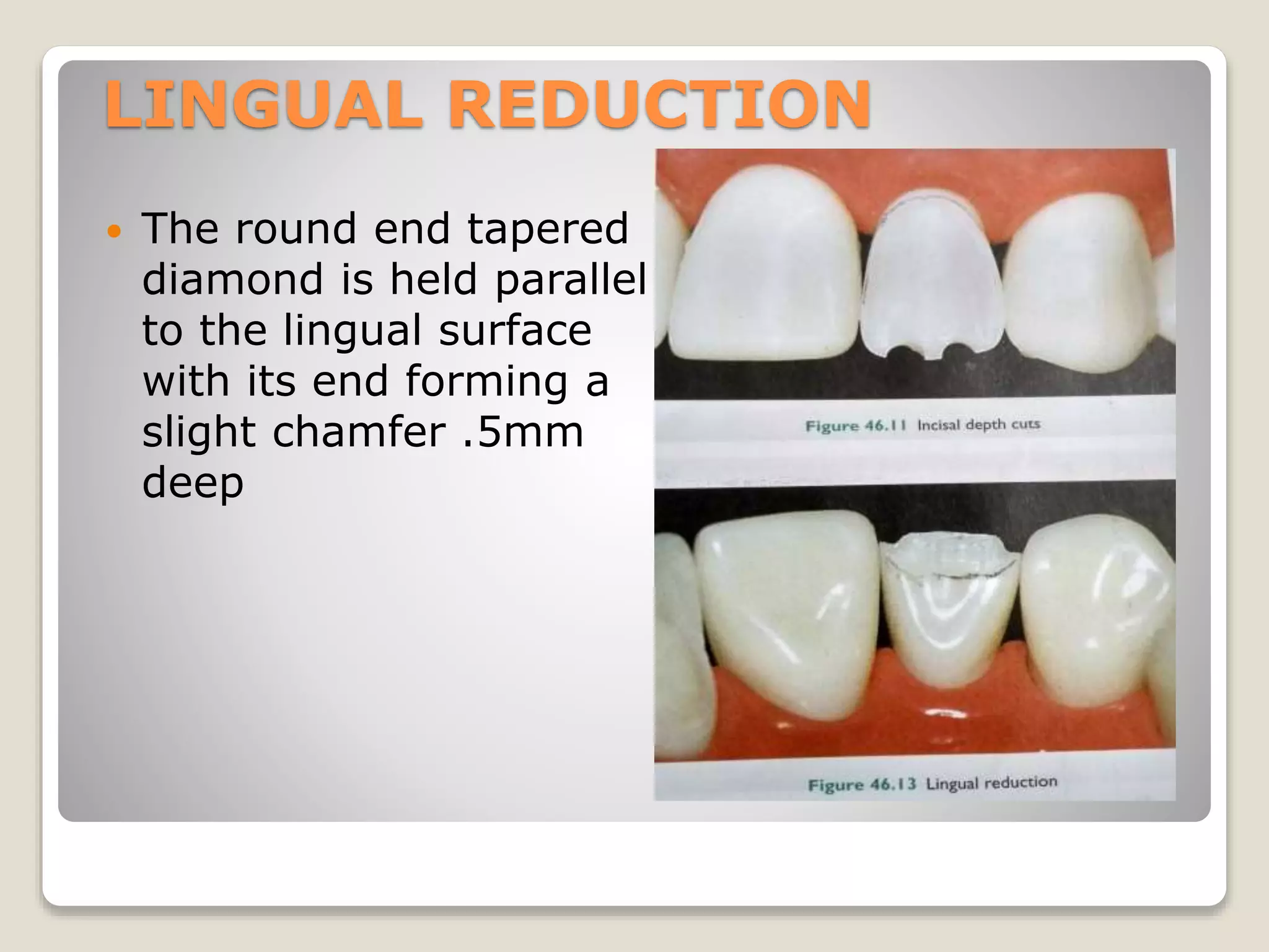 CERAMIC LAMINATE VENEERS.pptx