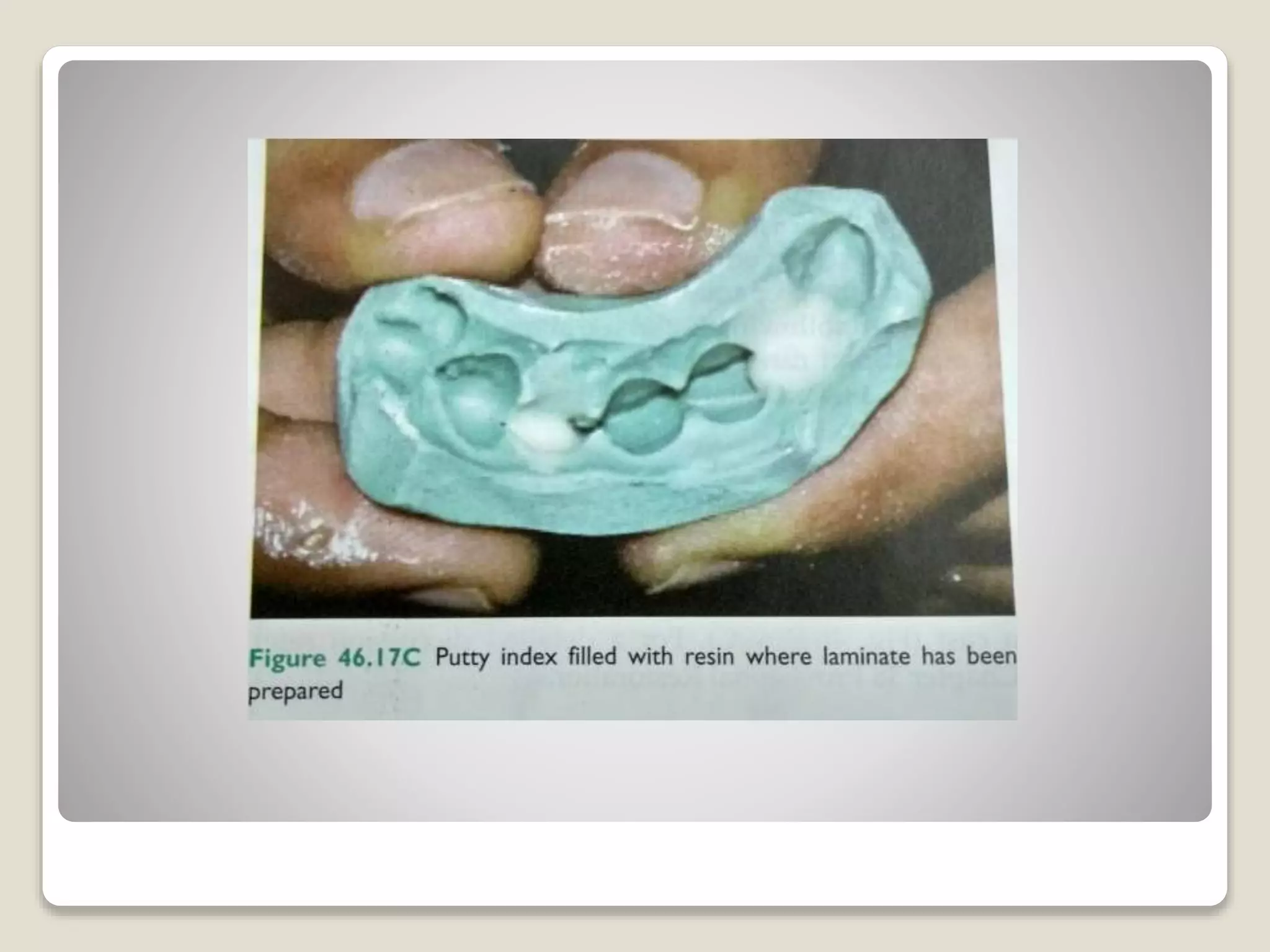 CERAMIC LAMINATE VENEERS.pptx
