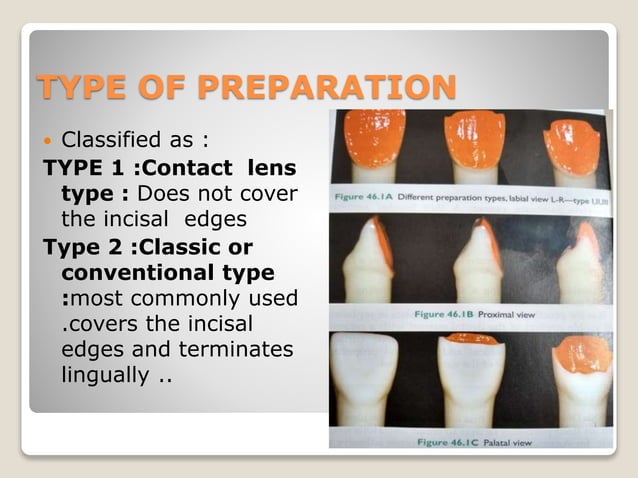 CERAMIC LAMINATE VENEERS.pptx | Dental Health | Diseases and Conditions