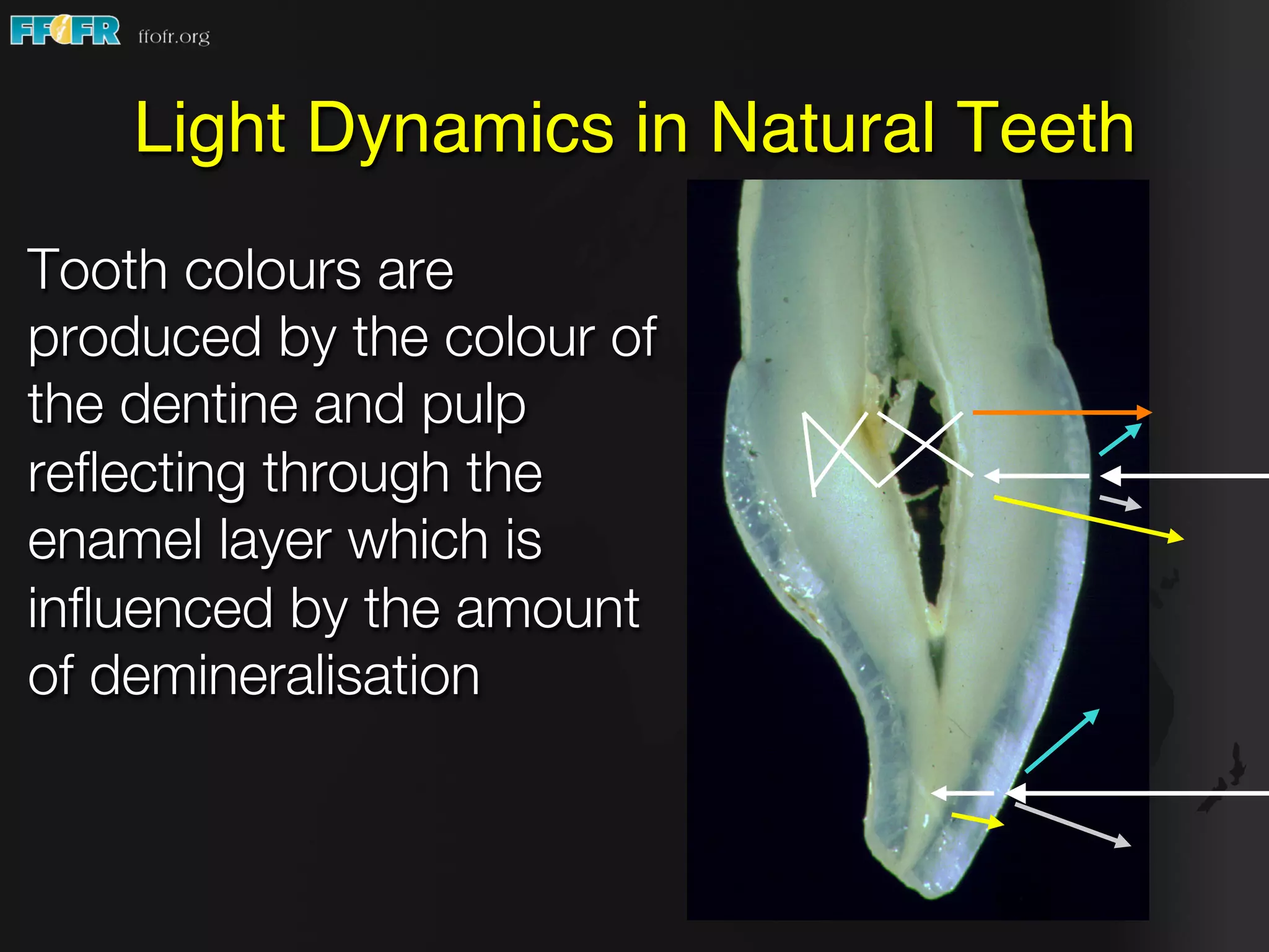 Ceramics in fixed prosthodontics considerations for use in dental ...