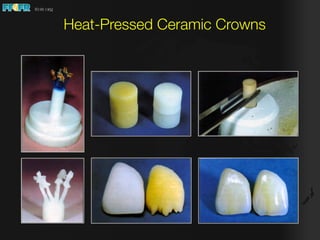 Ceramics in fixed prosthodontics considerations for use in dental ...