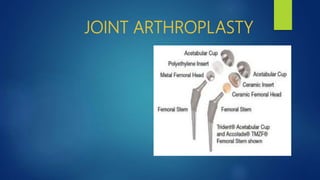 Ceramics in orthopaedics. | PPTX