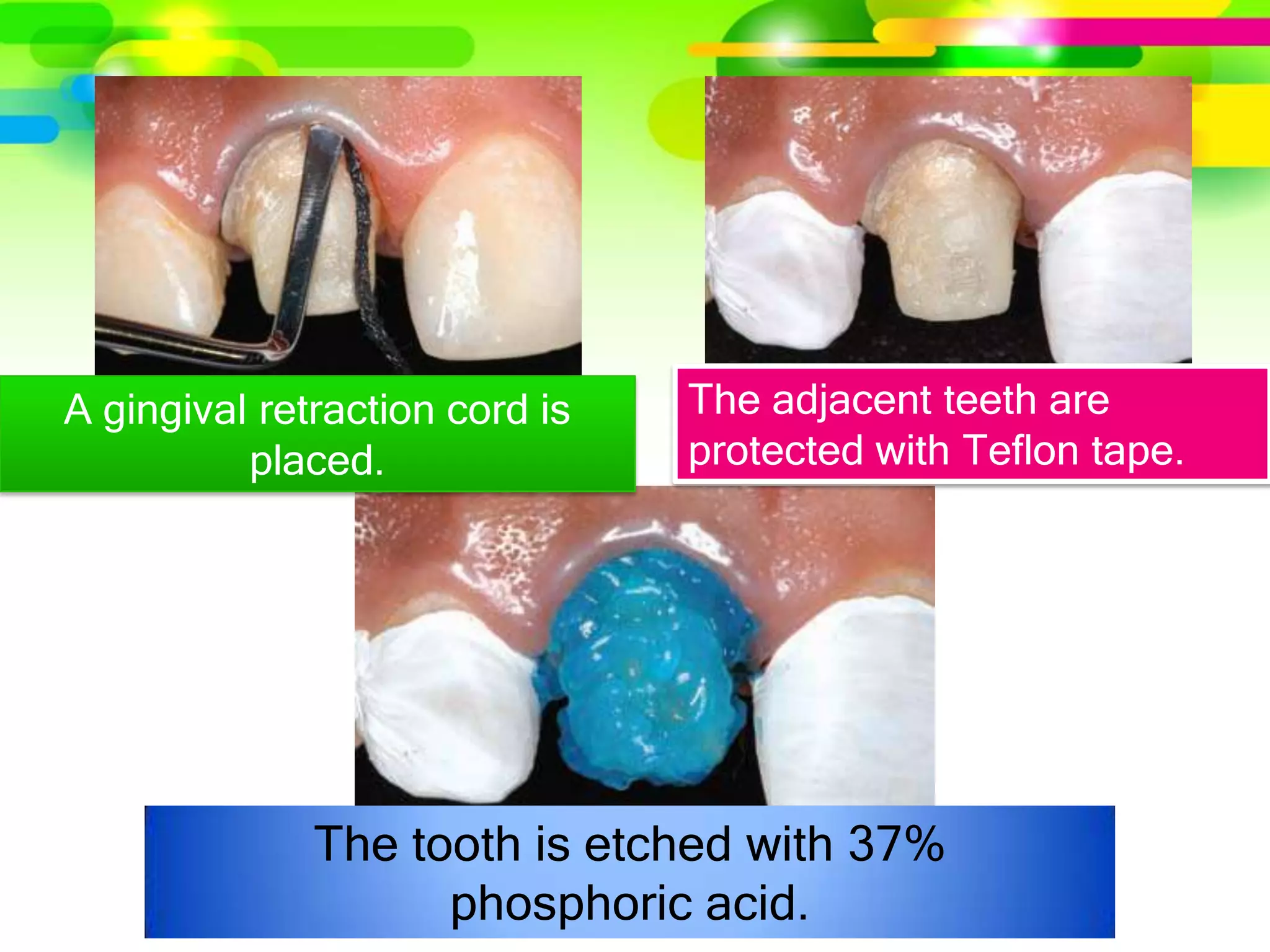 Ceramics strengthening techniques | PPTX