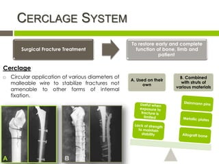 Cercage cables | PPTX