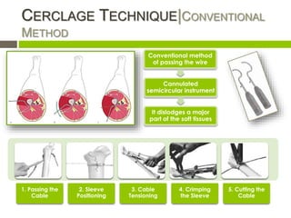 Cercage cables | PPTX