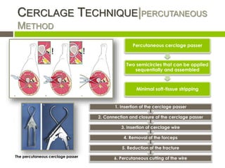 Cercage cables | PPTX
