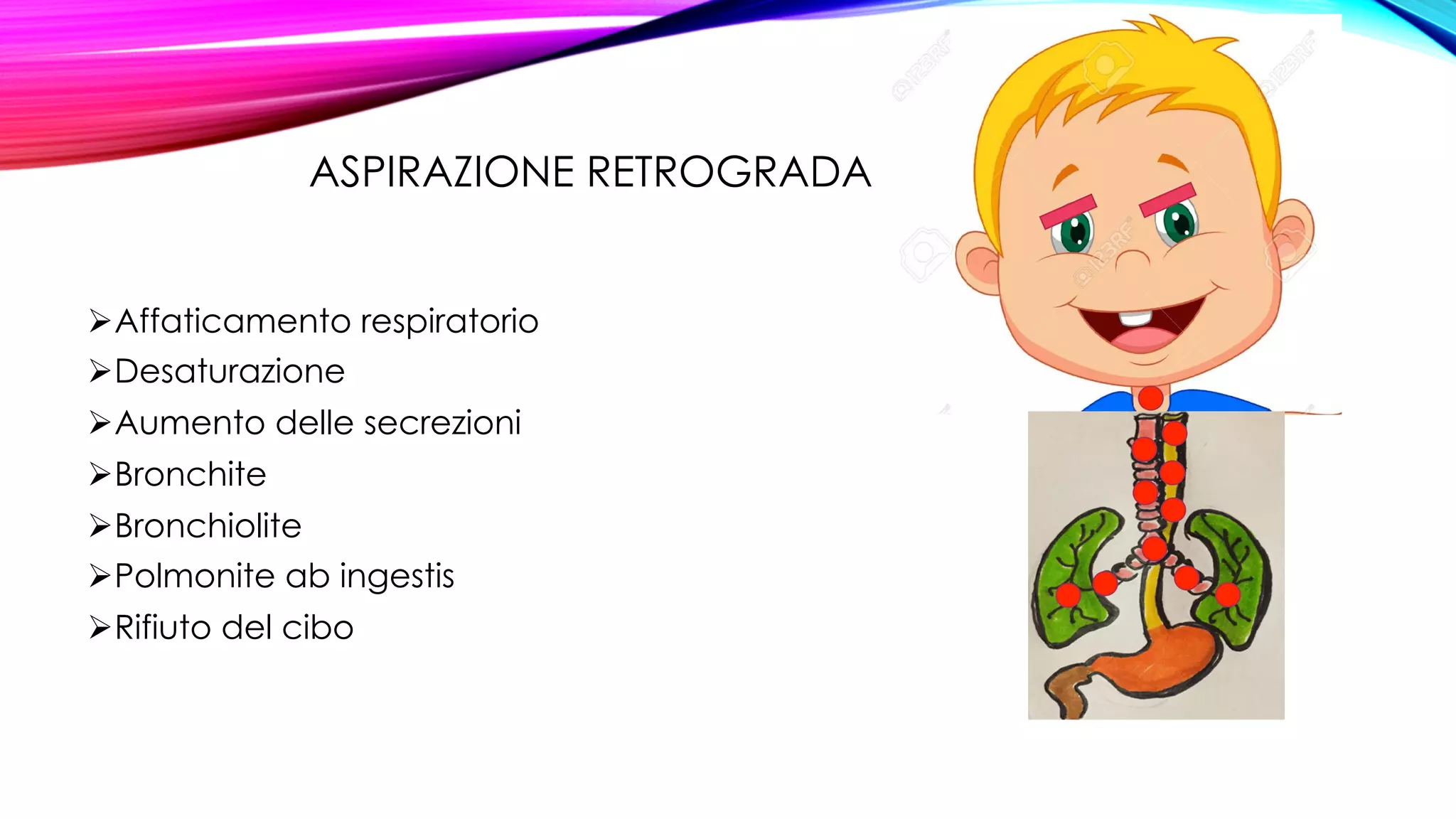 Atresia Esofagea - Disfagia e avversione al cibo | PDF