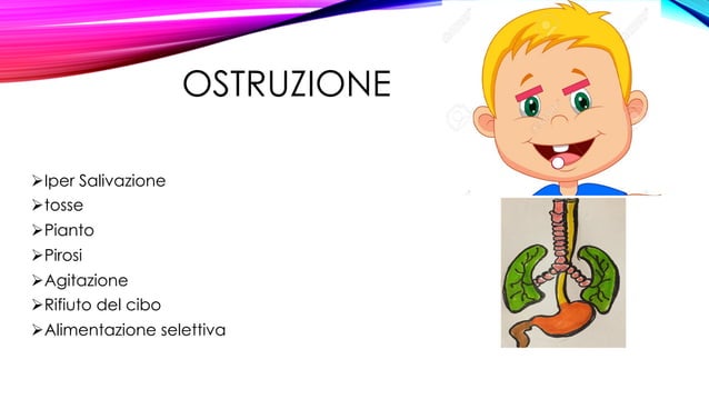 Atresia Esofagea - Disfagia e avversione al cibo | PDF