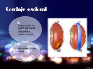 Cerclaje | PPT