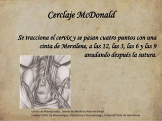 Cerclaje | PPTX