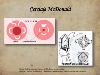Cerclaje | PPTX