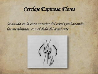 Cerclaje | PPTX