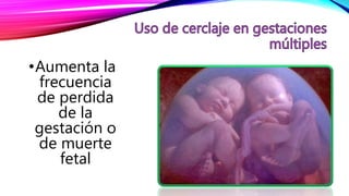 Cerclaje cervical | PPTX