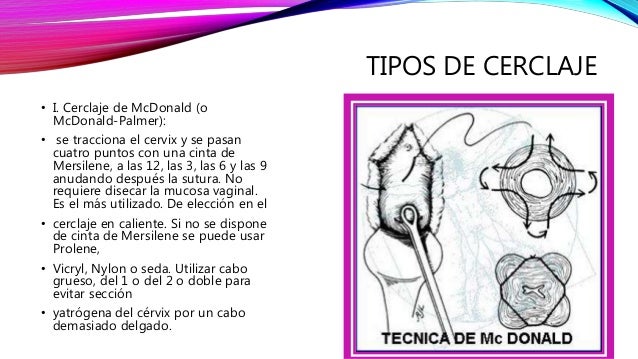 Cerclaje cervical