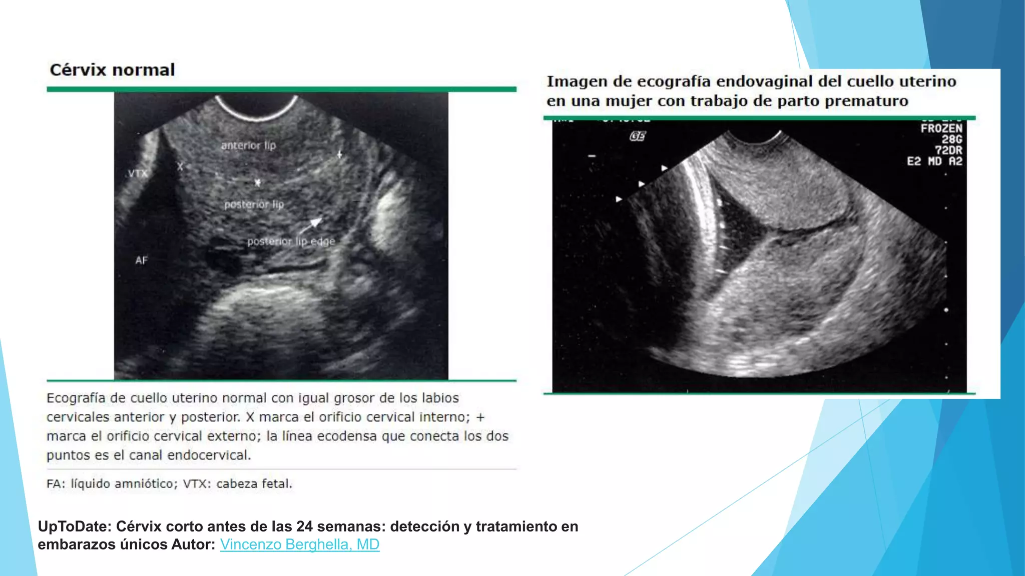 Cerclaje cervical | PPTX