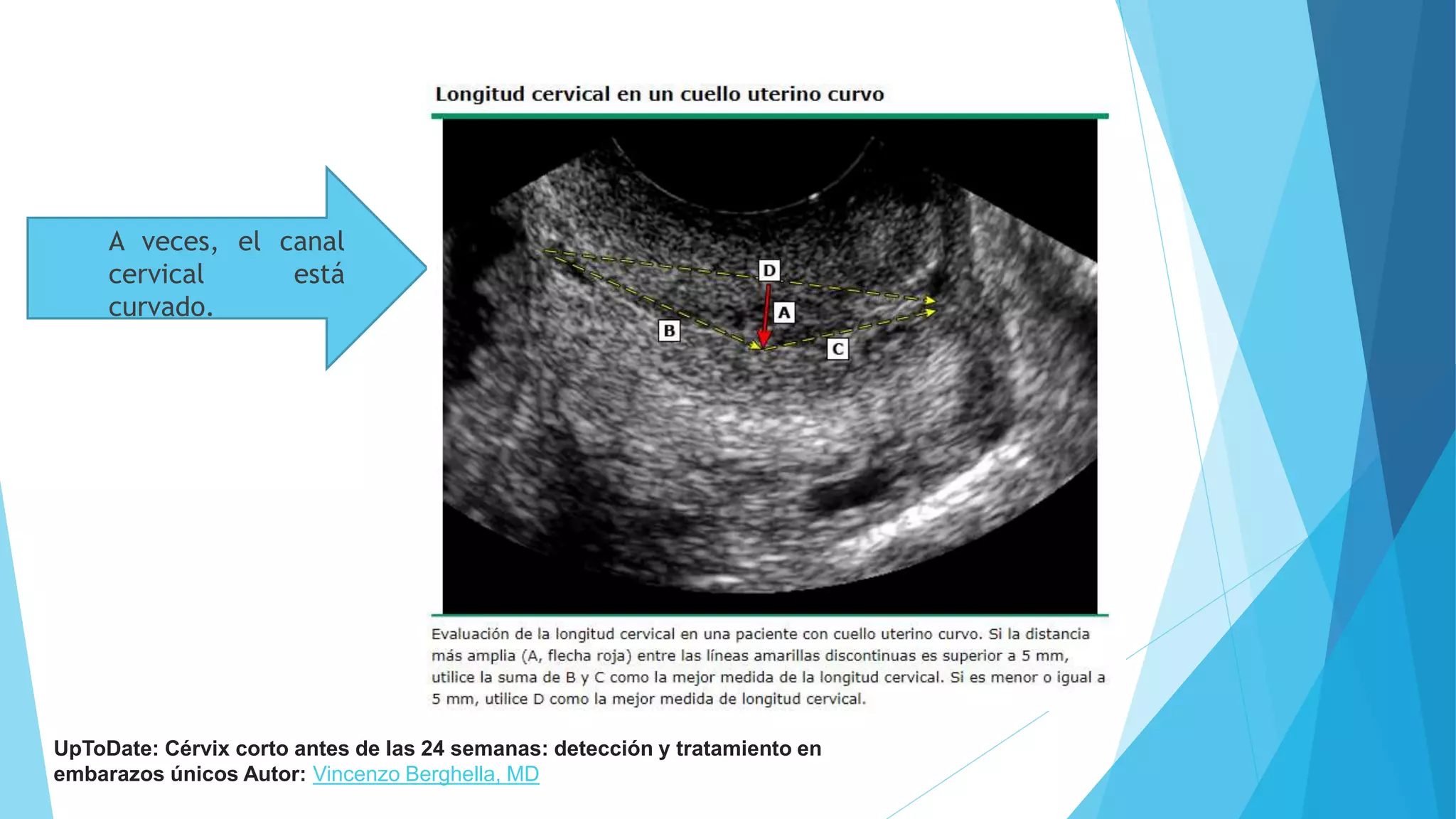 Cerclaje cervical | PPTX