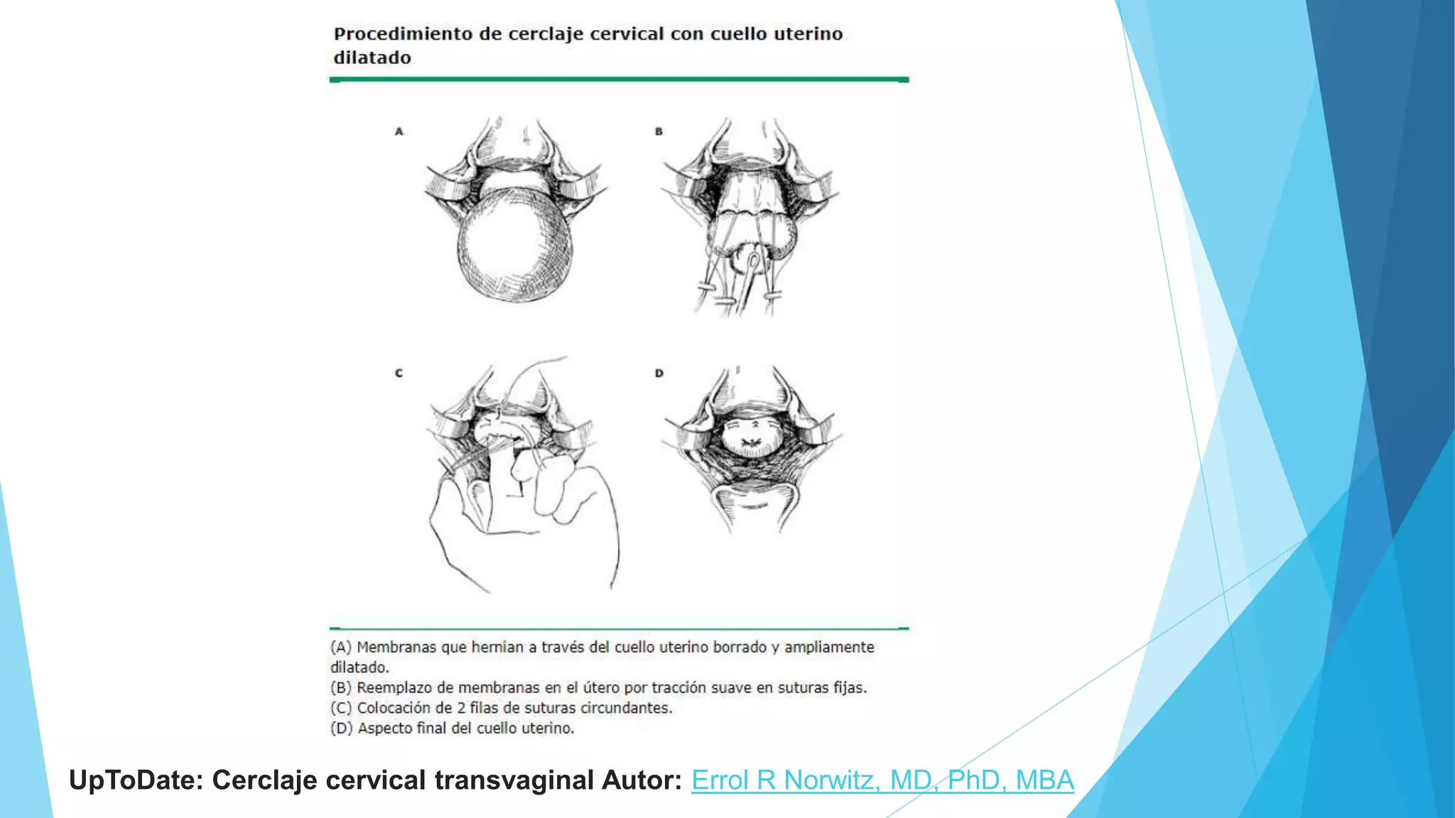 Cerclaje cervical | PPTX