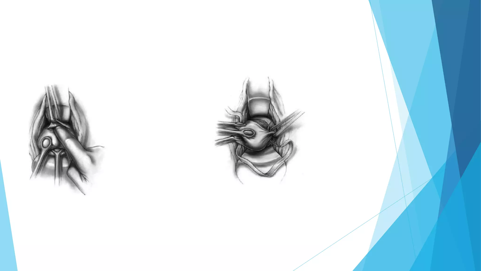 Cerclaje cervical | PPTX