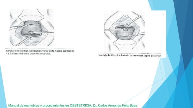 Cerclaje cervical | PPTX