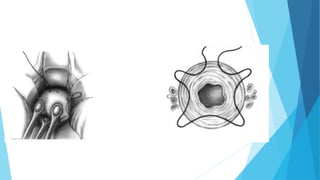 Cerclaje cervical | PPTX