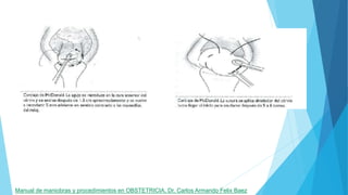 Cerclaje cervical | PPTX