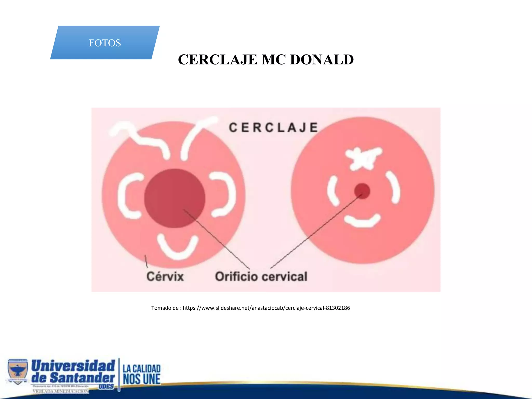 Cerclaje de cuello uterino | PPTX