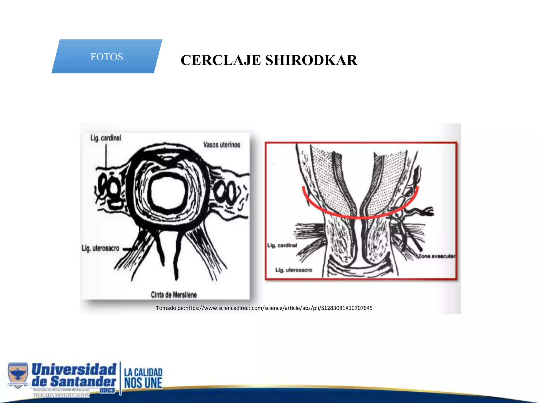 Cerclaje de cuello uterino | PPTX