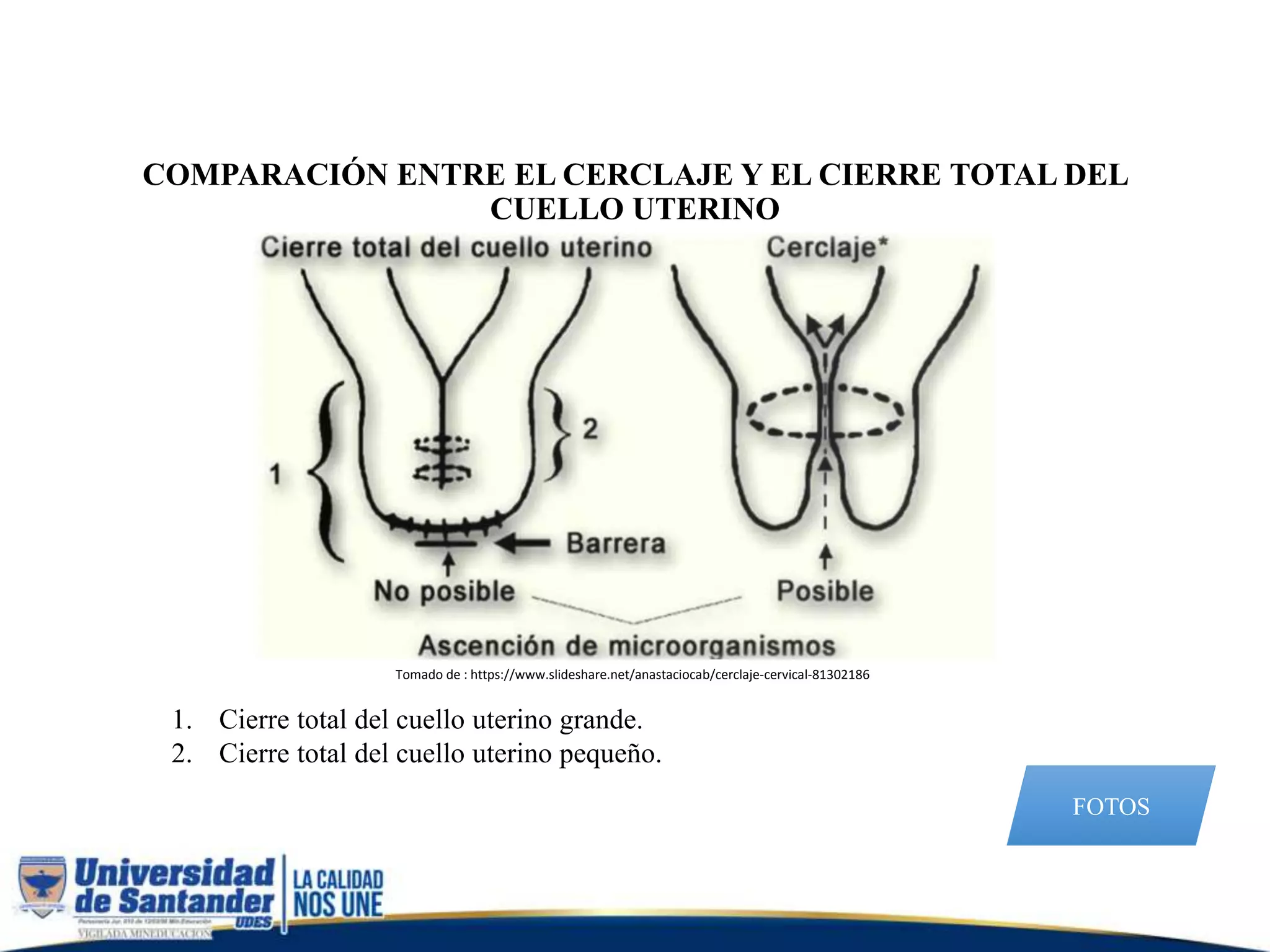 Cerclaje de cuello uterino | PPTX