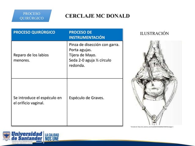 Cerclaje de cuello uterino | PPTX